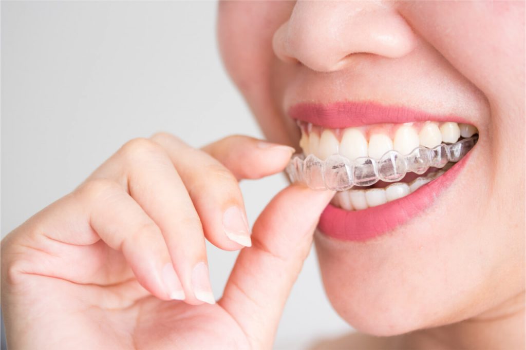What is an Invisalign Passive Aligner | soapgoddess.com