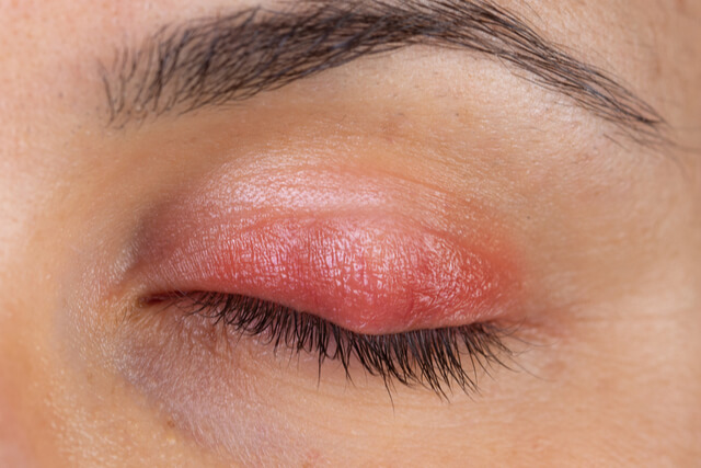 What Are the Most Common Causes of a Swollen Eye Lid?